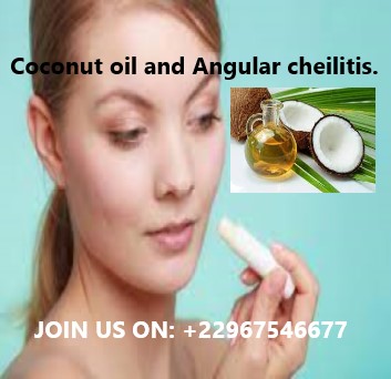 Coconut oil and Angular cheilitis.